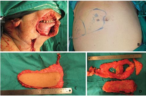 Segmental Mandibulectomy Buccal Mucosa Skin Periumbilical Download Scientific Diagram