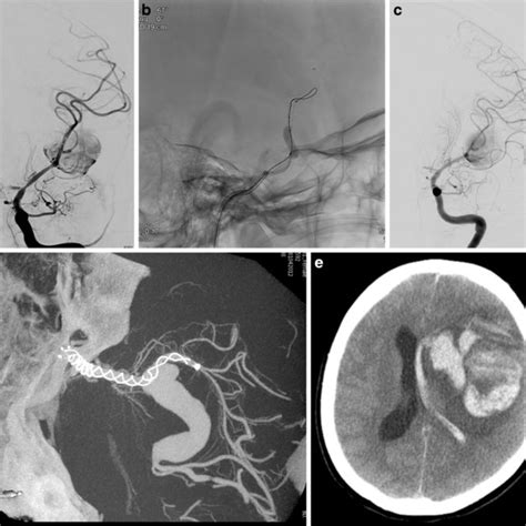 A Year Old Female Patient Presenting With Diplopia And Left Sided Download Scientific