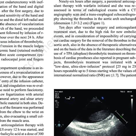 Trans Esophageal Echocardiography Showing Aortic Arch Mural Thrombus