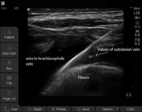 Ultrasound Guided Cannulation Of The Brachiocephalic Vein In Infants