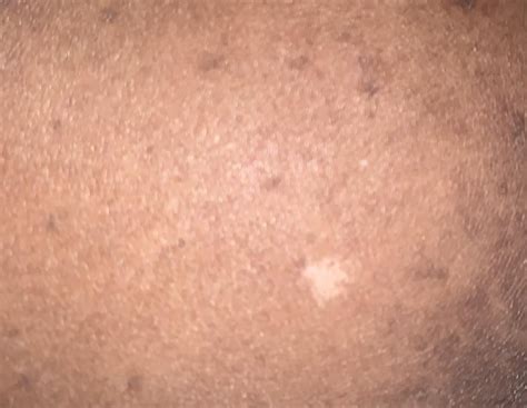 Is This The Early Stage Of Vitiligo R Vitiligo