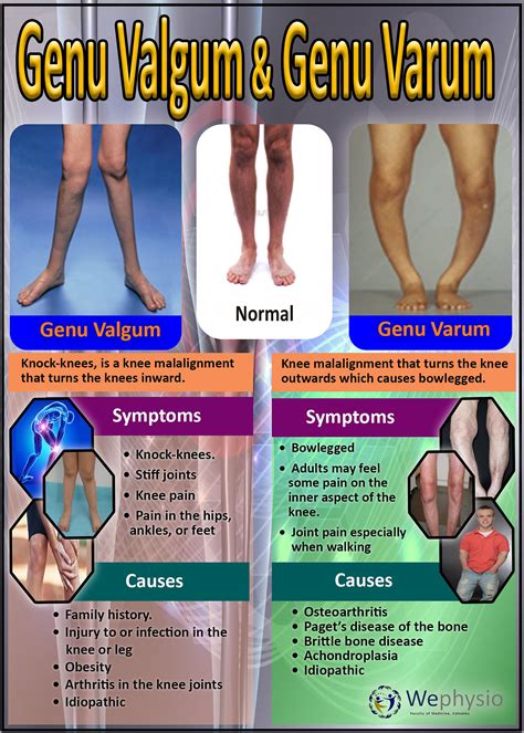 Mild Genu Valgum Treatment