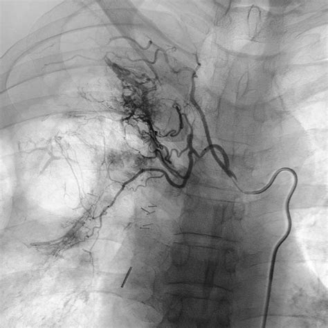 Angiografía O Arteriografía Servei