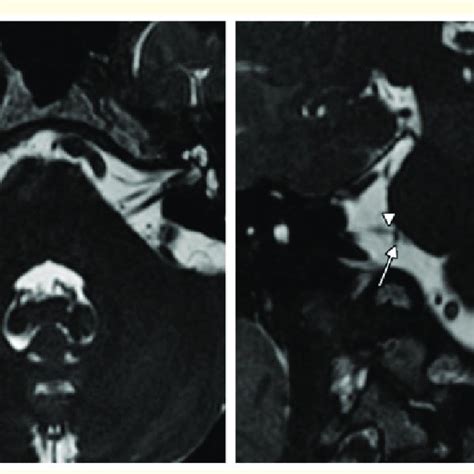 Arterial Contact Along The Proximal Cisternal Segment Of The Facial Download Scientific Diagram