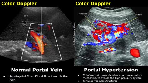 Portal Vein Color And Spectral Doppler Ultrasound Normal Vs Abnormal