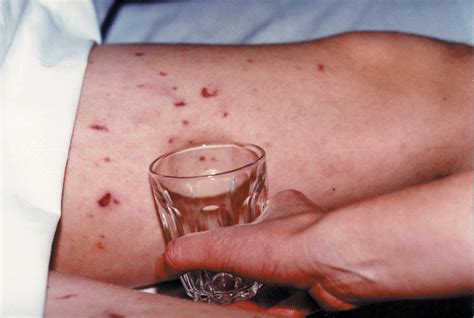How To Check Meningitis Autumnbenefit16