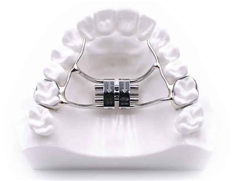 Rpe Rapid Palatal Expander — Tri Valley Orthodontics
