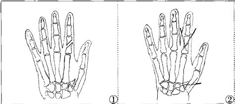 复合指掌骨骨折 外科学 医学