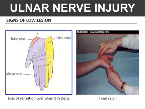 Peripheral Nerve Injuries Pptx
