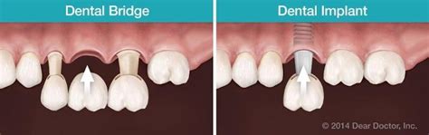 Dr Michael Huang Dds Blog Dental Bridges Vs Dental Implant