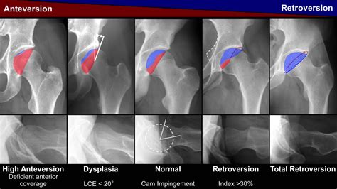 S Steppacher Pelvic Incidence In Acetabular Retroversion Hip Symposium 2018 Youtube