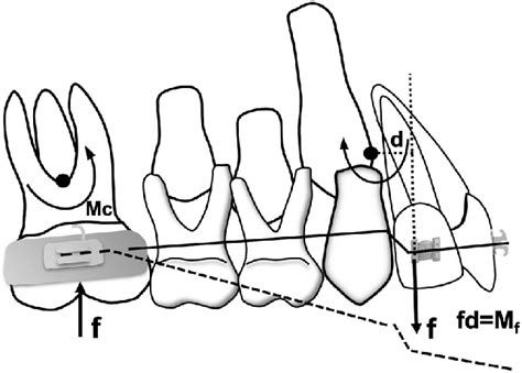 Schematic Drawing Of The Extrusion Arch Force System Download