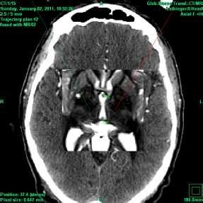 The Mr Image Is Overlaid As A Square On The Stereotactic Ct Scan At The