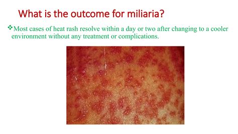 Miliariaheat Rash Obstruction Of Sweat Glands Pptx Pptx