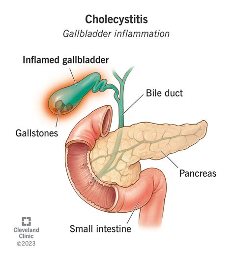 Inflamed Gallbladder Symptoms How Is Cholecystitis Diagnosed And