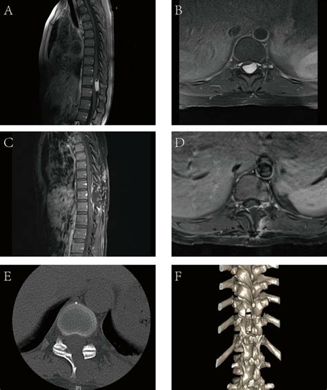 Endoscopic Laminectomy At Rachel Morgan Blog