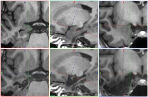 Segmentation Of Piriform Cortex On Pre Top Row And Post Bottom Row