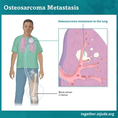 Ostéosarcome Chez Les Enfants Et Les Adolescents Ensemble By St Jude