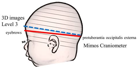 Cranial Shape Measurements Obtained Using A Caliper And Elastic Bands Are Useful For