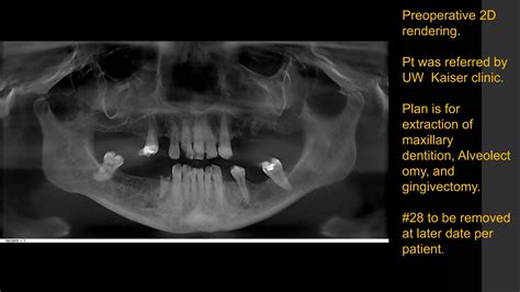 Extraction Of Maxillary Anterior Dentition Alveolectomy Gingivectomy Pptx