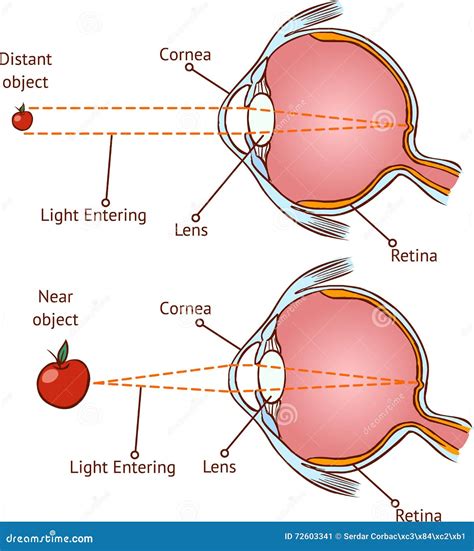 Myopia And Normal Vision Stock Vector Illustration Of Anatomical 72603341