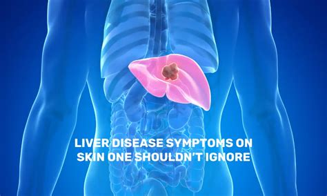 Liver Disease Symptoms On Skin One Should Not Ignore Healthstory