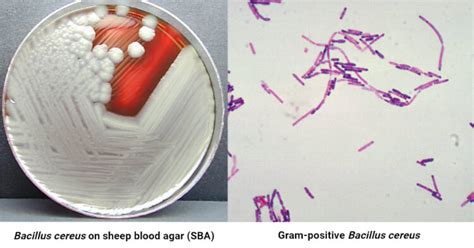 Bacillus Cereus Food Poisoning With Foodborne Toxins