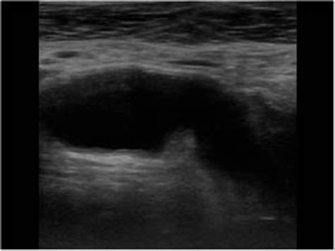 Abdomen And Retroperitoneum 16 Gastrointestinal Tract Case 167 Duodenum And Small Bowel
