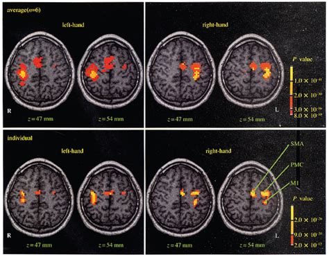Statistical Parametric Maps Of Brain Activation The Upper Panel Shows