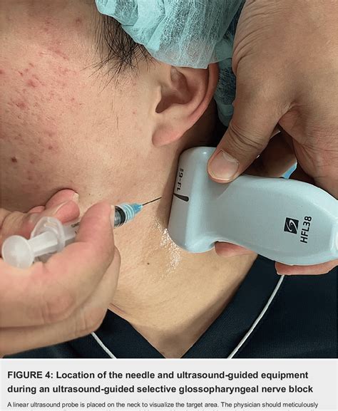 Figure 4 From Intraoperative Ultrasound Guided Selective Glossopharyngeal Nerve Block For Post