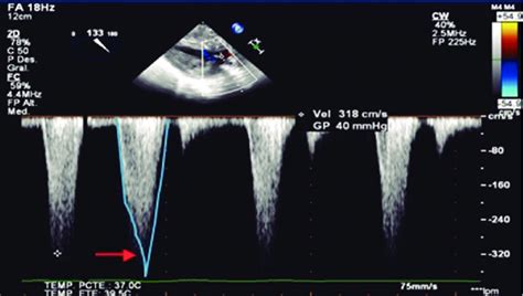Intraventricular Dynamic Gradient With Late Peak Arrow Download Scientific Diagram