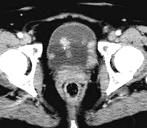 Mdct Urography Exploring A New Paradigm For Imaging Of Bladder Cancer