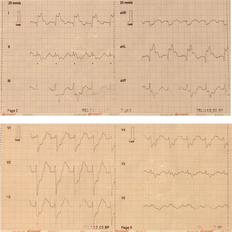 Prevalence Of Pseudoinfarction Patterns In The Setting Of Acute Hyperkalaemia More In Comments