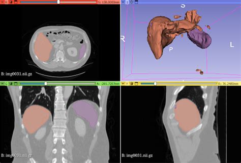 How Can We Use Our Trained Model As Pretrained Model In Monailabel D Slicer Project Monai