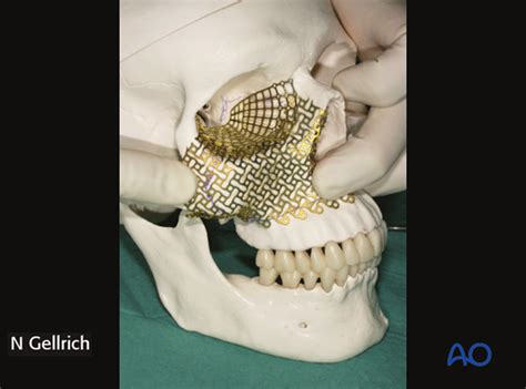 Midface Reconstruction