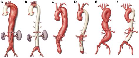 Comparison Of Open Thoracoabdominal Repair For Chronic Aortic