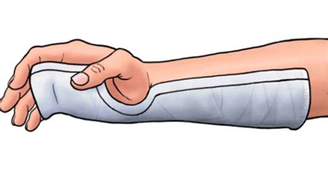 Week 11 And 13 Splinting Ppt Flashcards Quizlet