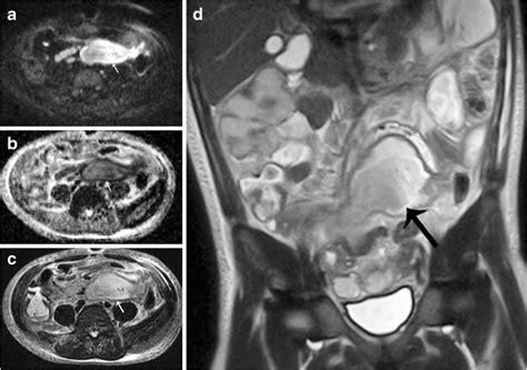 Deep Mesenteric Abscess In A 10 Year Old Boy With A History Of