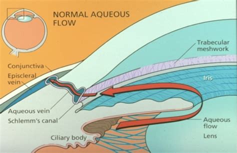 Glaucoma Flashcards Quizlet