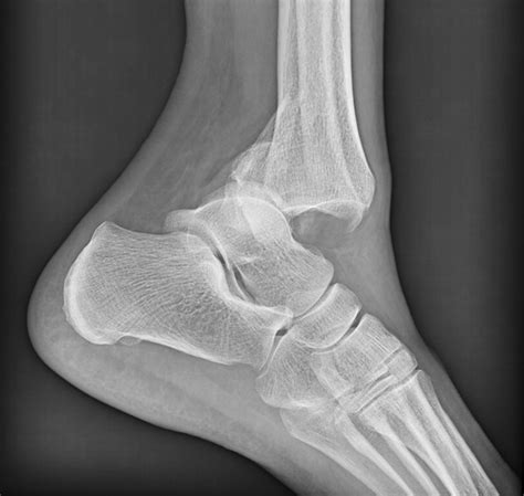 Trimal Ankle Fracture Dislocation Meded Cases