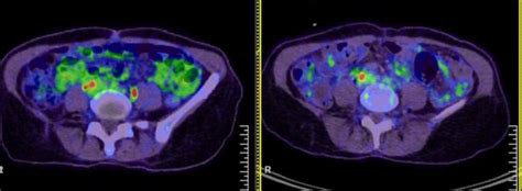 Persistence Of The Previously Noted Fdg Avid Right Common Iliac Node In