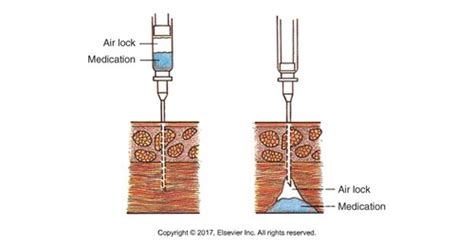 Administering Intradermal Subcutaneous And Intramuscular Injections Flashcards Quizlet