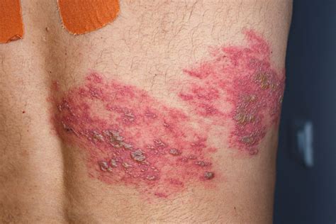 Types Of Skin Lesions 7 Hidden Causes Doral Health And Wellness Ny