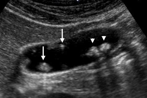 Multiple Gallbladder Polyps Benign Gallbladder Diseases Imaging