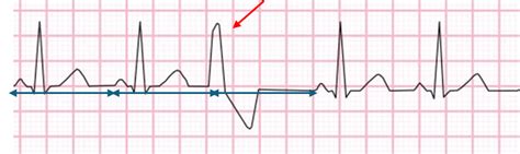 심방 심실 조기수축 Pac Pvc 메디톡