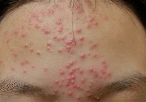 피부질환 여드름의 발생 원인과 예방 방법및 여드름 치료 방법