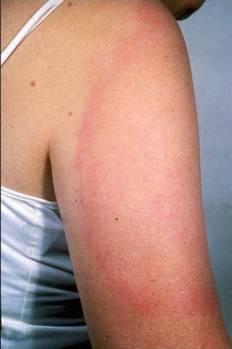 Multiple Erythema Migrans