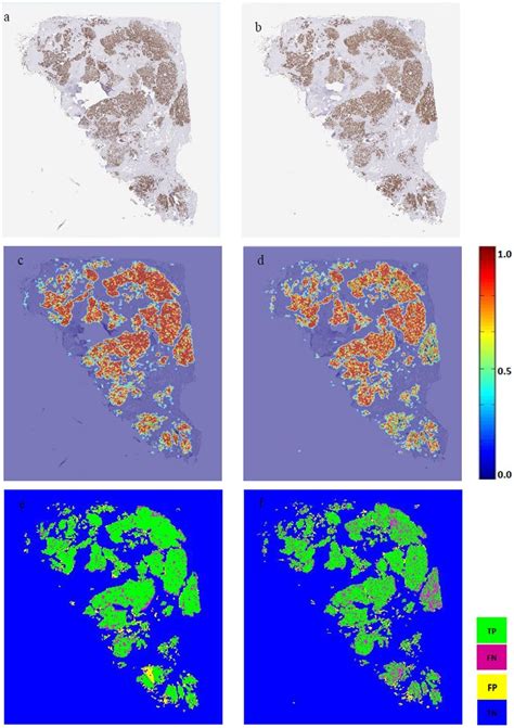 Representative Examples Of Whole Slide Breast Cancer Images Stained Download Scientific Diagram