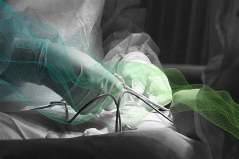 Icg Guided Laparoscopic Lymphadenectomy In Gastric Cancer Long Term