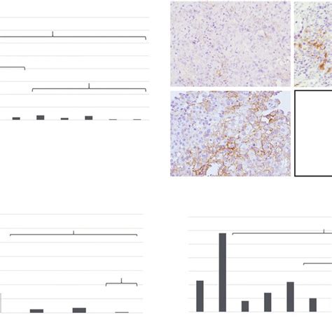 Pd L1 And Pd 1 Expression Of Tcs And Tils In Mpm Patients A Of All